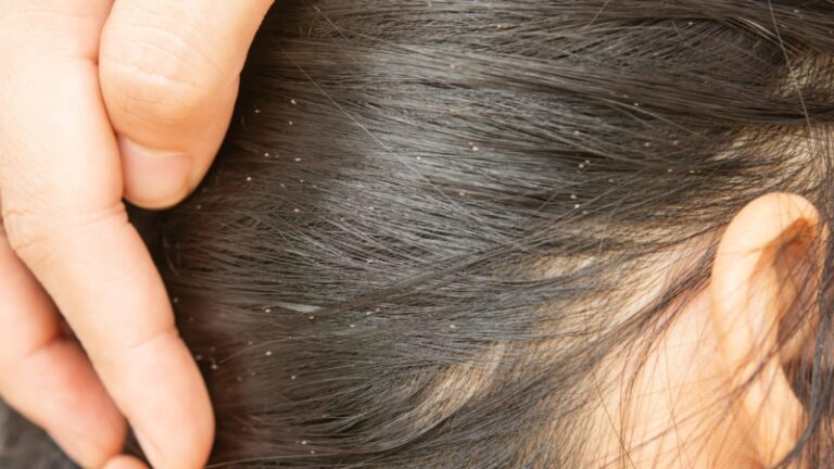 What Causes Lice Infestation? | All You Need to Know! - Pest Samurai