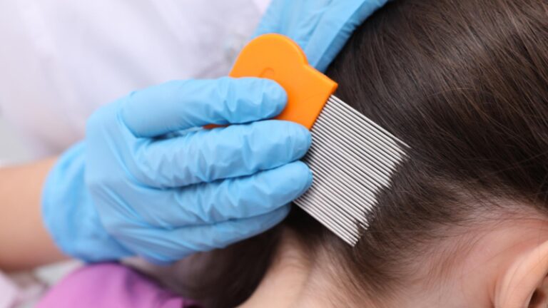 What Causes Lice Infestation? | All You Need to Know! - Pest Samurai