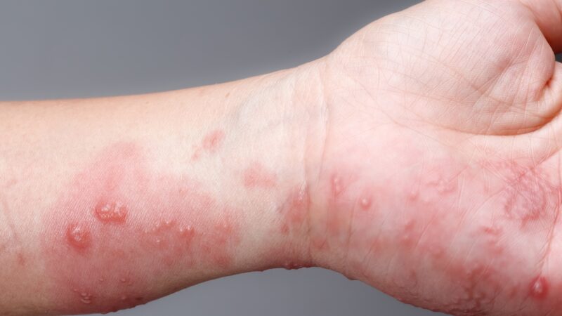 The Bug Bite Survival Guide Identifying And Treating Bites Pest Samurai